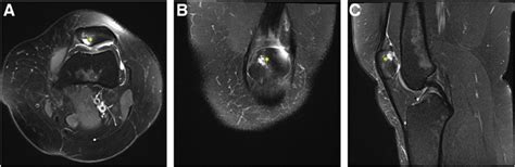 Preoperative Magnetic Resonance Imaging Left Knee Chondral Defect And