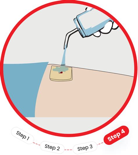 Chitosan Wound Dressing Products Axiostat Vascular Patch