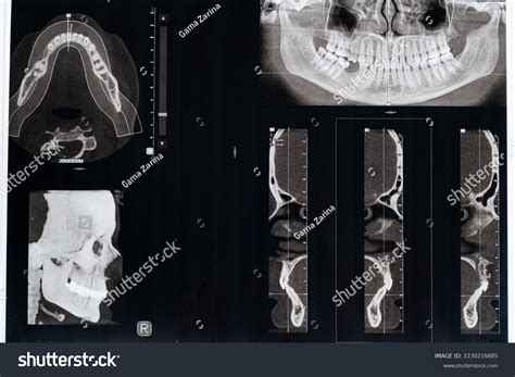 Tmd X Ray 18 รายการ ภาพ ภาพสต็อกและเวกเตอร์ Shutterstock