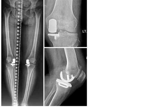 Postoperative Scannogram Of The Bilateral Lower Limb And Anterior Download Scientific Diagram
