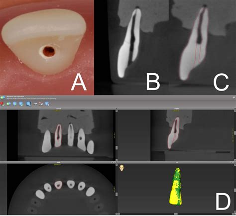 Dynamic Navigation In Endodontics Guided Access Cavity Preparation By