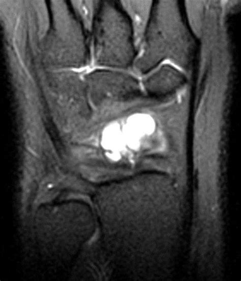 Wrist Ganglion Cysts Radsource