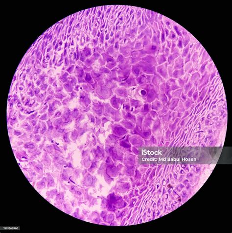 Squamous Papilloma Of Maxilla To The Human Papilloma Virus Squamous Cell Papilloma Benign Growth