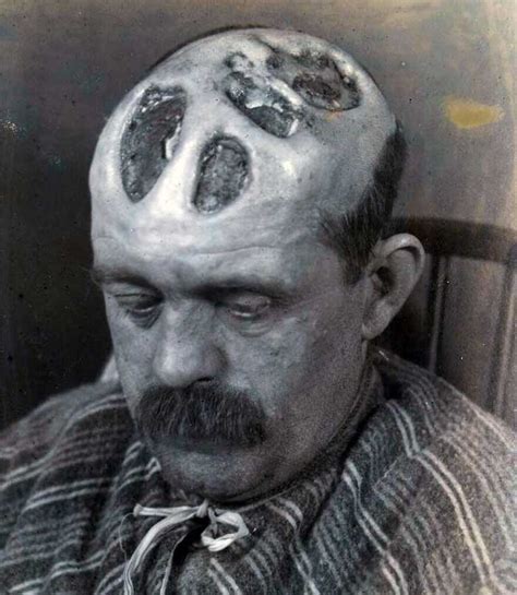 Pictures Syphilis All Stages [warning Strong Images]