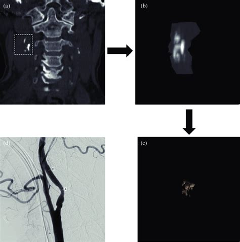 Calculation Of Plaque Volume In A Step By Step Fashion Using The