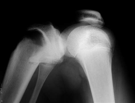 Definite Swelling Of The Upper Outline Of The Tibia Figure 2 The