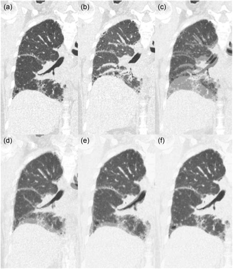 Sequential Registration Processes For A Precise Image Registration Of