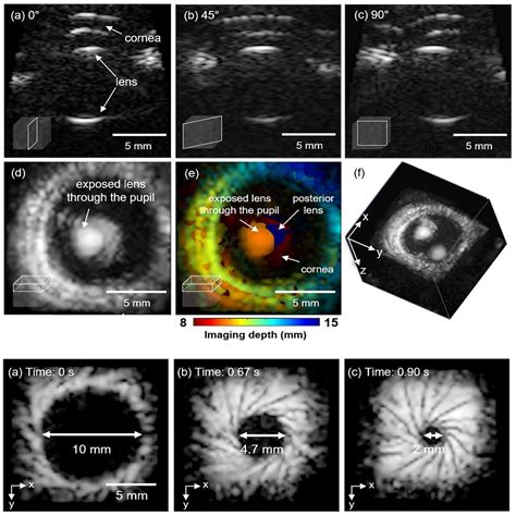 Ultrasound Pupilometer