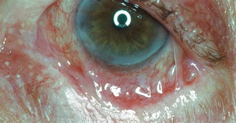 Ocular Pemphigoid