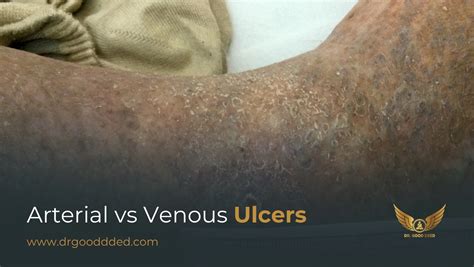 Arterial Vs Venous Ulcers Key Differences Symptoms And Treatment