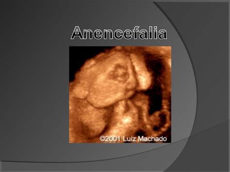 Anencefalia