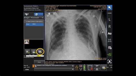 Ge Healthcare Awarded Fda Clearance For Pneumothorax Detection Algorithm