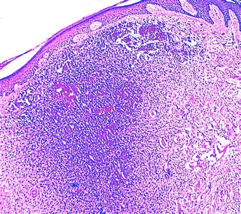 Pathology Outlines Dermatofibroma Benign Fibrous Histiocytoma