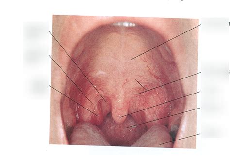 Anterior Tonsillar Pillar