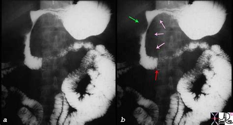 Duodenum The Common Vein