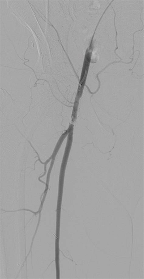 What Does A Vascular Study Show At Aidan Whyte Blog