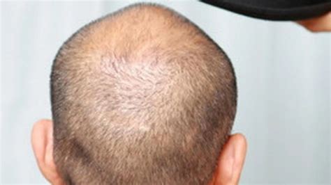 Foto Rambut Tiga Jenis Kebotakan Yang Biasa Dialami Masyarakat Kebanyakan