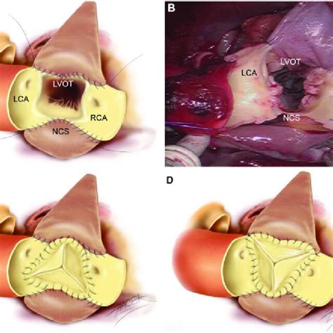 Enlargement Of The Aortic Annulus By Pericardial Patches A Schematic