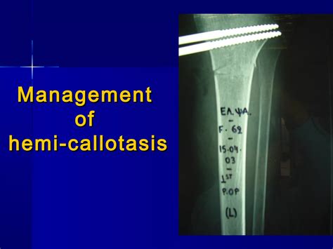 Upper Tibial Valgus Osteotomy Using A Dynamic External Fixator Ppt