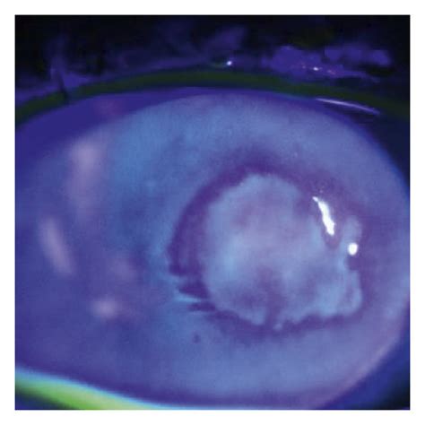 Representative Cases Of Endophthalmitis Caused By Moraxella Species In