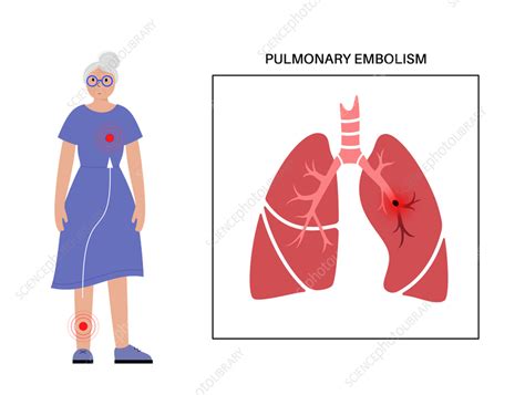 Pulmonary Embolism Illustration Stock Image F036 6467 Science Photo Library