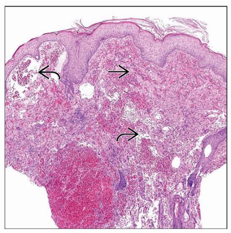 Angiosarcoma Basicmedical Key