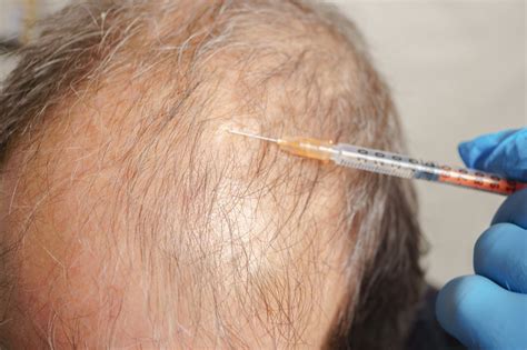 Injecting Fat Cells Into Scalp Could Stop Baldness