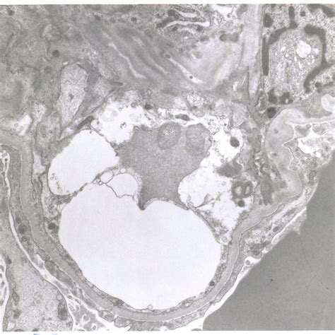 Electron Micrograph Demonstrating Effacement Of Podocyte Foot Processes