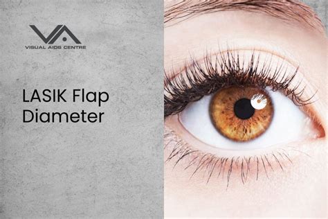 Lasik Flap Diameter What You Need To Know