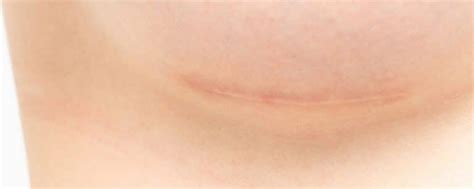 How To Reduce Scars After Breast Surgery Enhance Medical Group