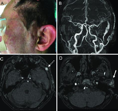 A A Preoperative Picture Of The Scalp Lesion Showing A Pulsatile Mass Download Scientific