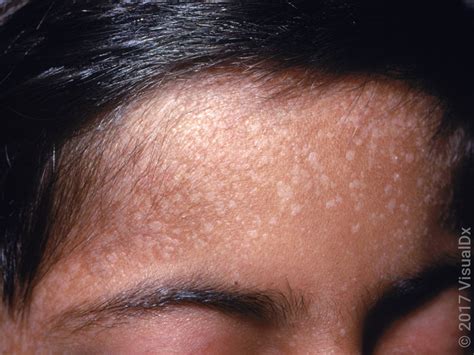 6 Pictures Of Warts And How To Treat Different Types Goodrx