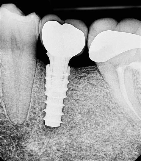 Single Tooth Replacement In The Mandibular Premolar Region Using A