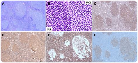 Blood And Hematology Composite Mantle Cell Lymphoma And Small