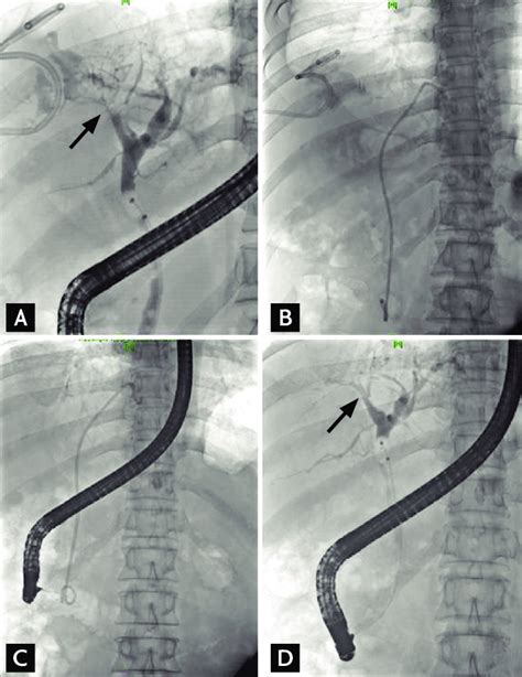 Representative Patient Bile Leak After S4 Segmentectomy Endoscopic Download Scientific