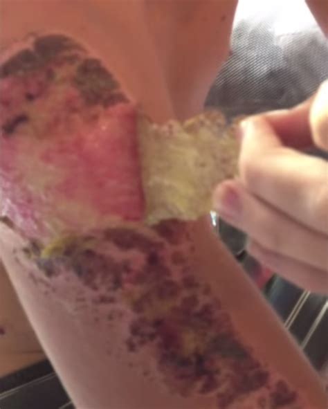 Scab Peeling