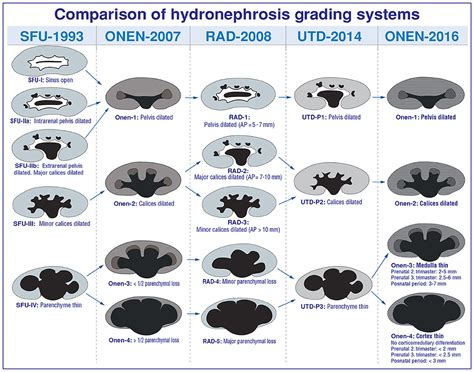 Hydronephrosis Grading Ultrasound