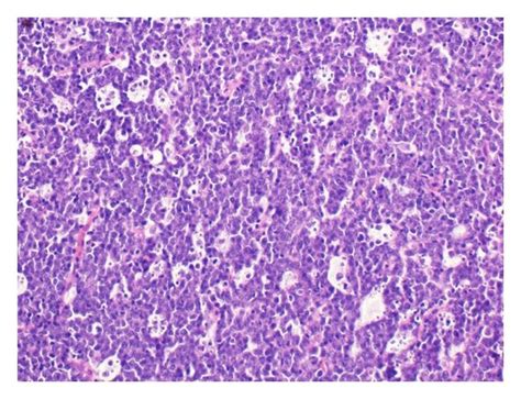 Tingible Body Macrophage とは Tリンパ芽球性リンパ腫 生存率 Ukuru