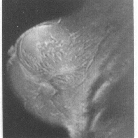 Benign Post Surgical Scar Spiculated Density On A Mammogram And B