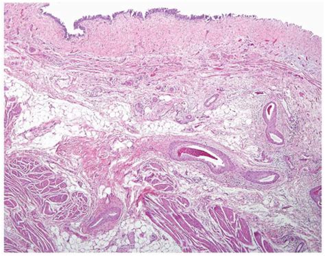 Normal Bladder Anatomy And Variants Of Normal Histology Abdominal Key