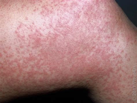 Allergic Reactions To Antibiotics Symptoms And Rash Images Goodrx
