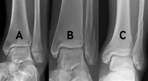 Weber Fracture