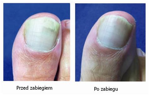 Wstydliwy Problem Grzybica Paznokci Jak Rozpoznać Jak Leczyć