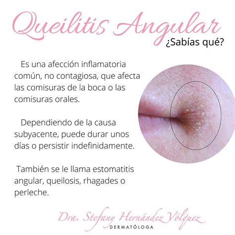 Queilitis Angular Grave
