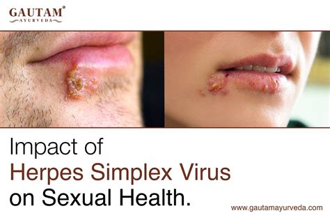Impact Of Herpes Simplex Virus On Sexual Health By Gautamayuverda
