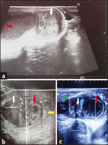 Scrotal Abscess Complicating Appendicular Perforation Peritonitis Pmc