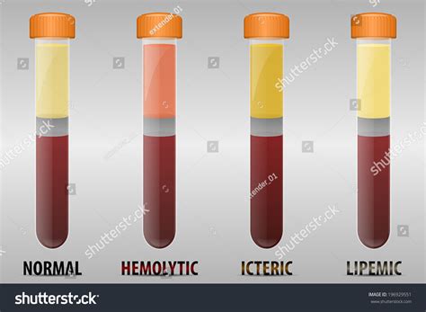Specimen Was Lipemic At Layla Helms Blog