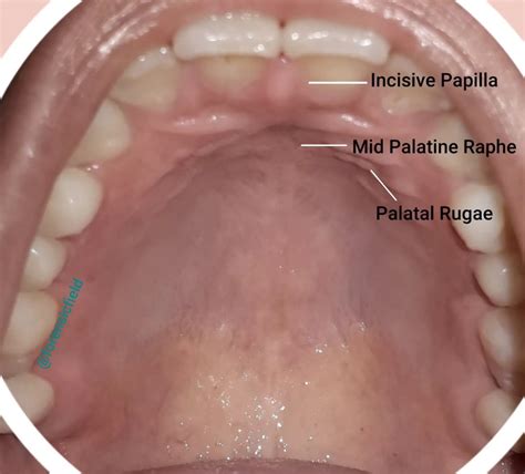 Palatal Rugae Forensics Blog