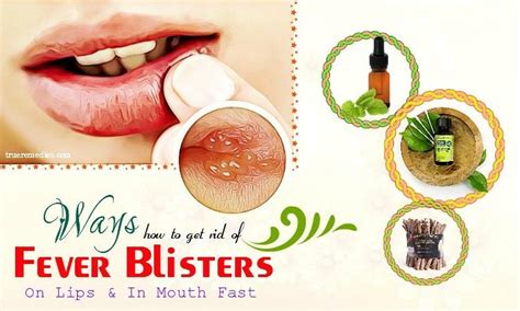 19 Ways How To Get Rid Of Fever Blisters On Lips And In Mouth Fast
