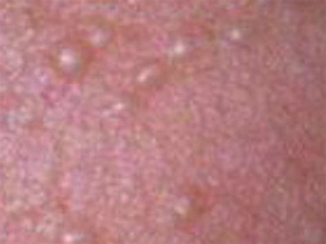 QuÉ Son Los Quistes De Milium Los Quistes De Milium Son Unas Bolitas Blancas De Pequeño Tamaño